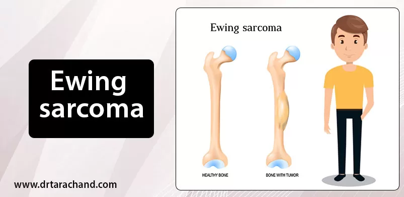 Understand Ewing Sarcoma What It Is Symptoms And Trea