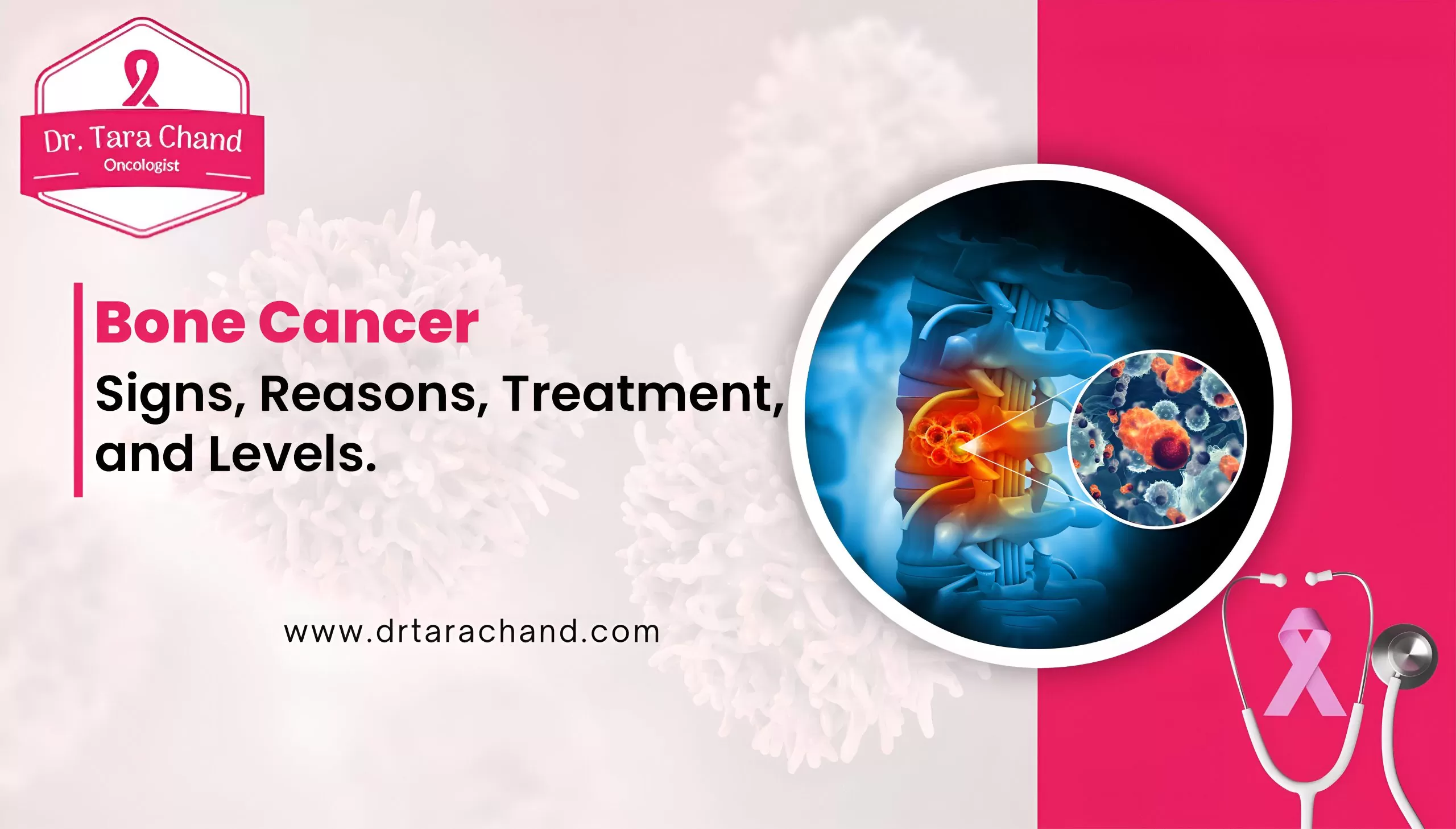 Bone Cancer: Types, Symptoms, Causes, Stages, and Treatment